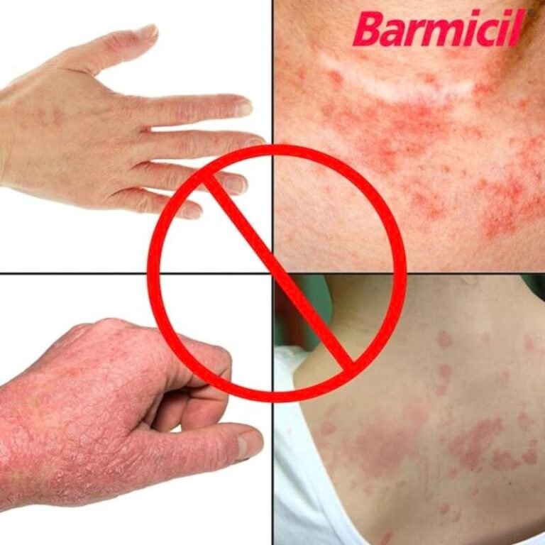 Barmicil Cream for Anti-Itch Relief – Hydrocortisone, Compuesto, Plus ...